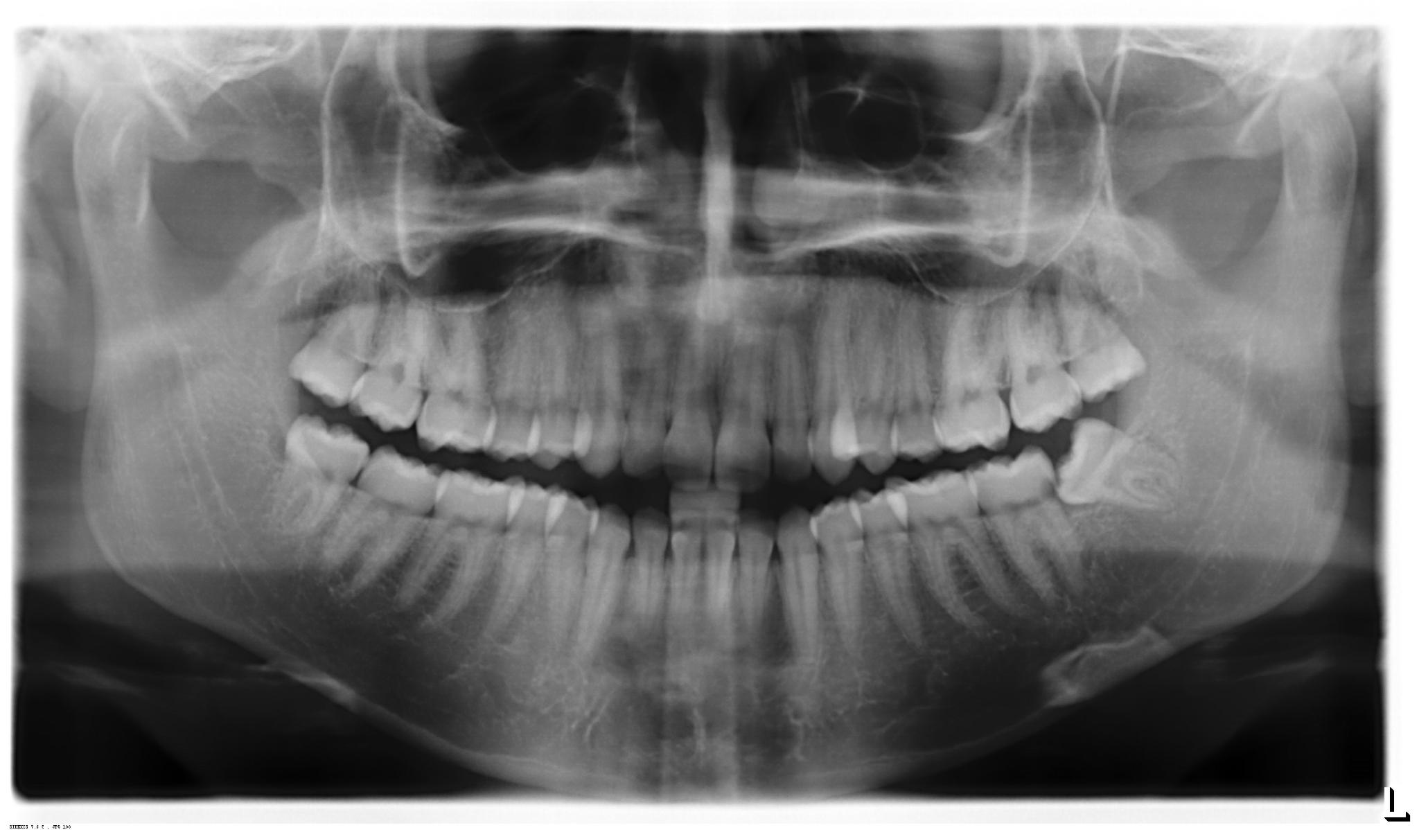 Weisheitszahnentfernung: Wann und Warum? - Oralchirurgen Düsseldorf